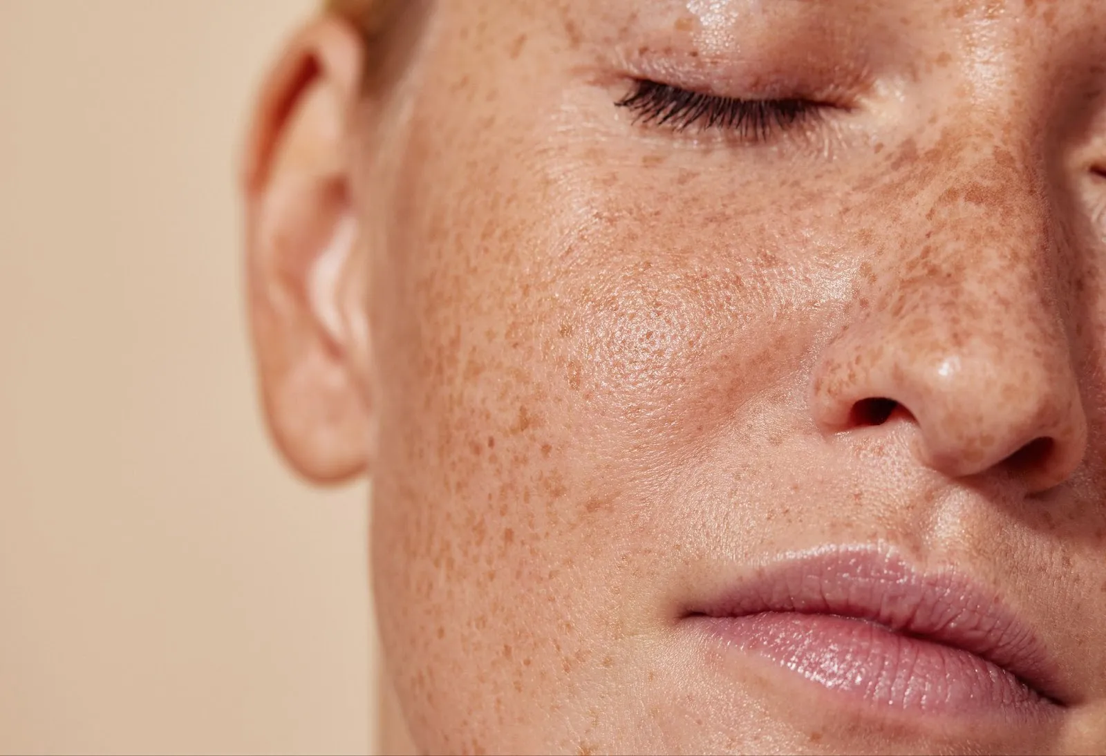 Best Melasma Treatment: What Works